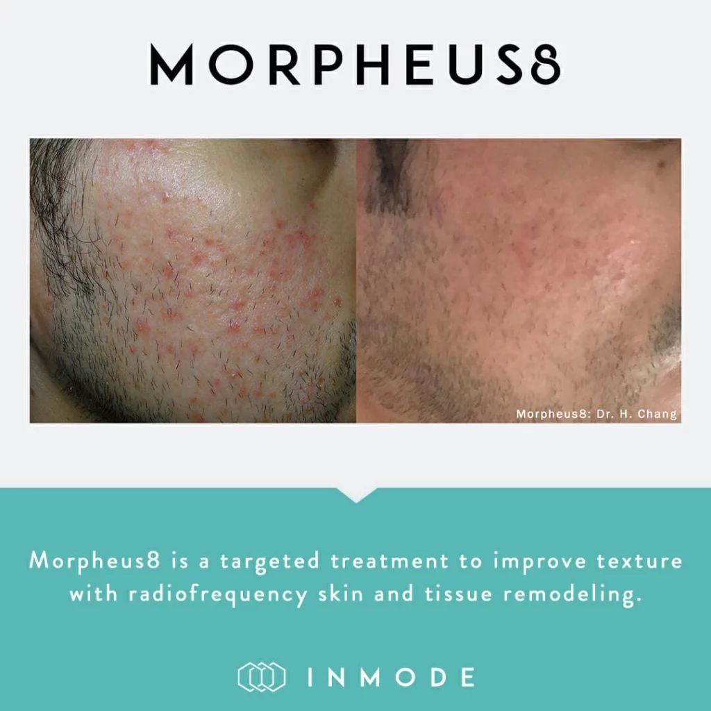 Morpheus 8 – Twoth Dental + Facial Aesthetics