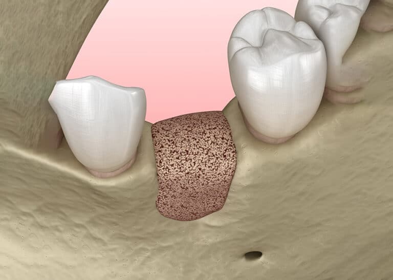 How Doped Glass Improves Bone Tissue Response